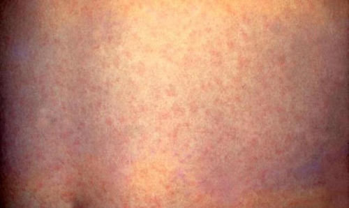 Rubella (German Measles): Symptoms, Rubella Rash, Congenital Rubella Syndrome and Pregnancy Effects