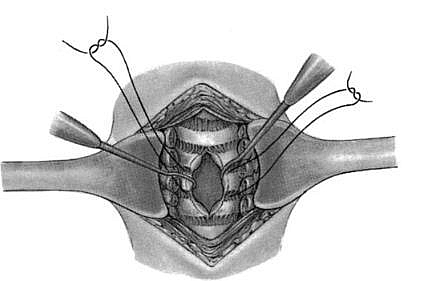 Tracheostomy (Tracheotomy): Procedure, Types, Care, Complications and ...