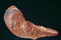 Miliary Tuberculosis (TB) Symptoms, Causes, Radiology, Diagnosis ...