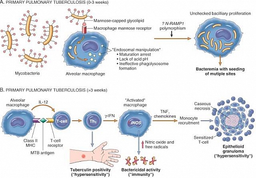 Pulmonary Tuberculosis Symptoms, Causes, Pathophysiology, Test ...