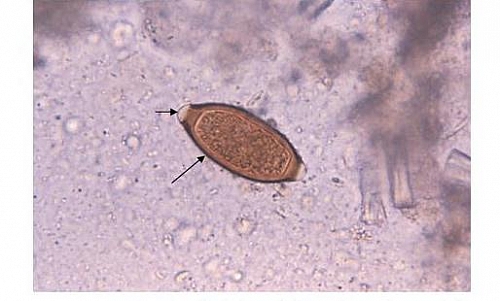 Trichuris Trichiura (Whipworm) Symptoms, Morphology, Egg, Life Cycle ...