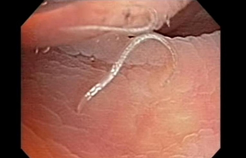 Trichuriasis Symptoms, Diagnosis, Mode of transmission, Treatment and ...